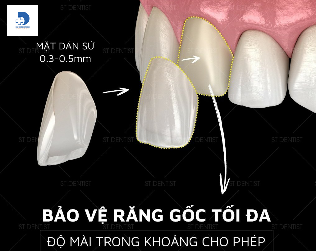 Dán sứ Veneer - Giải pháp thẩm mỹ được ưa chuộng hàng đầu hiện nay ...