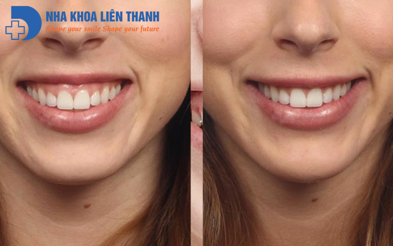 Cười hở lợi là gì? Các phương pháp điều trị cười hở lợi phổ biến nhất ...