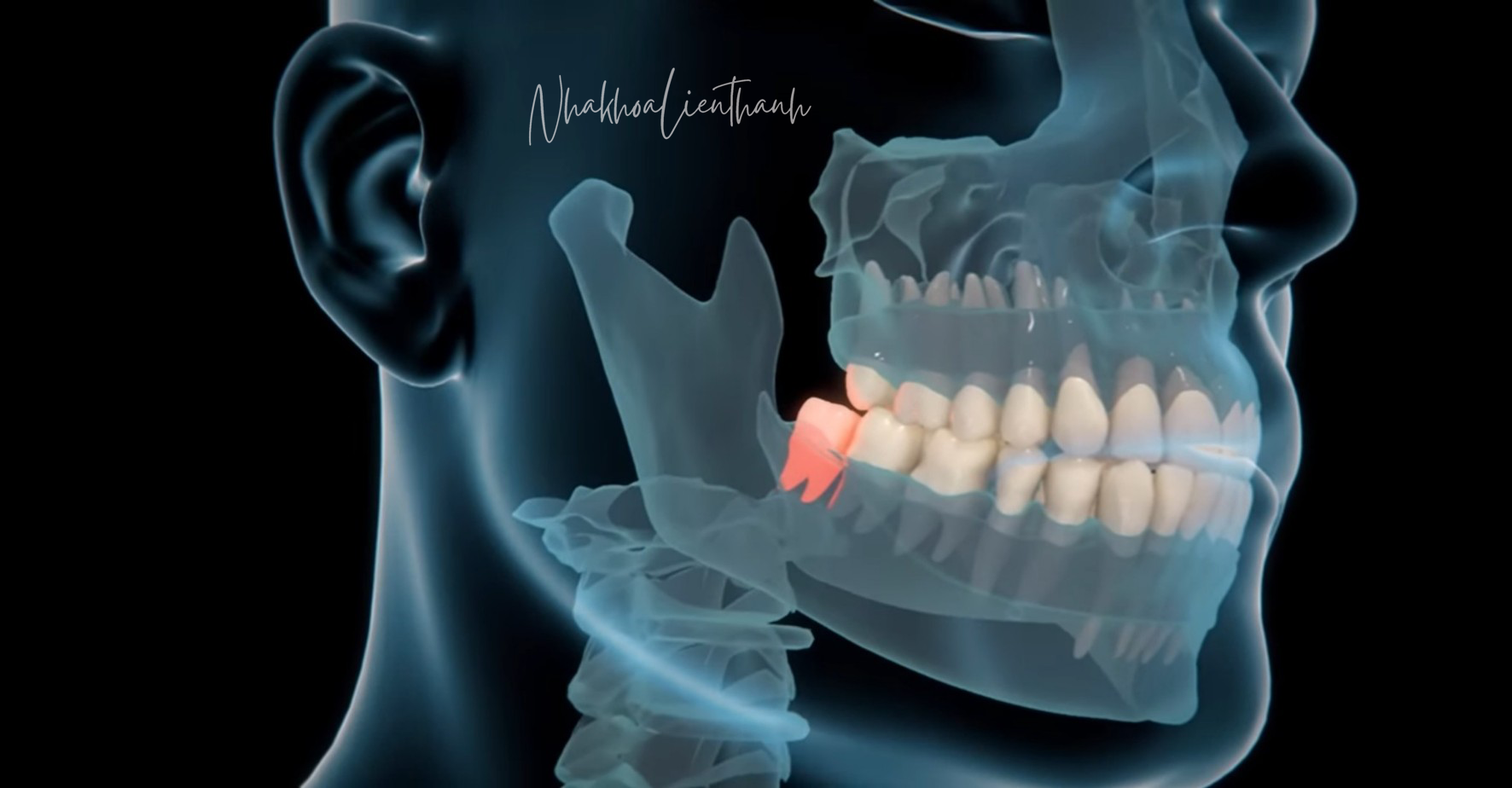 Dấu hiệu mọc răng khôn là gì? Những trường hợp nào phải nhổ răng khôn ...